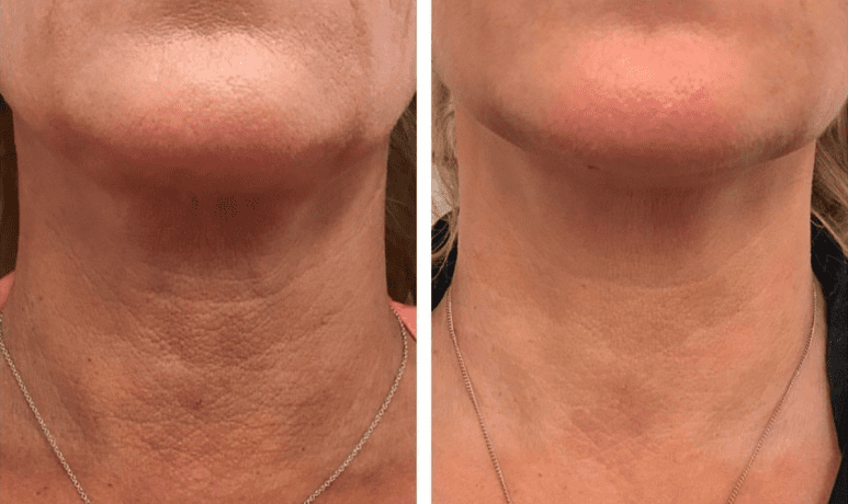 Hyperdilute Radiesse | True Radiance Medispa